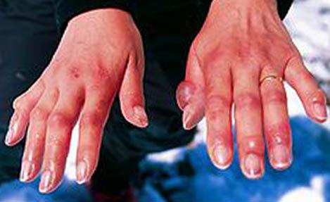 Soigner et soulager une engelure - Astuces Pratiques