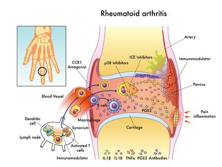 Que faire en cas de polyarthrite rhumatoïde - Astuces Pratiques